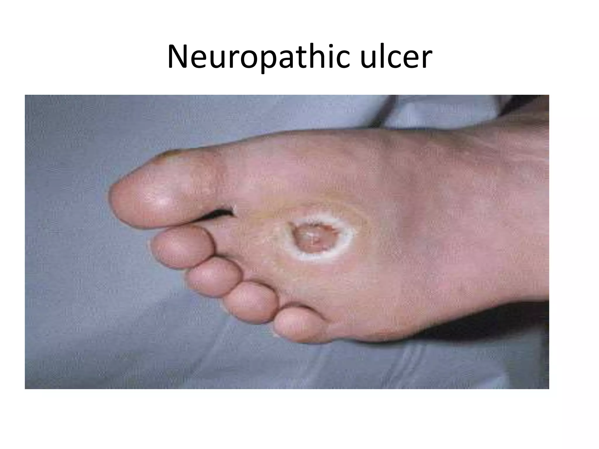 Physiotherapy Management for Wound Ulcers Rahul.AP BPT,MPT (CRD&ICU ...