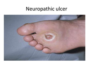 Physiotherapy Management for Wound Ulcers Rahul.AP BPT,MPT (CRD&ICU ...