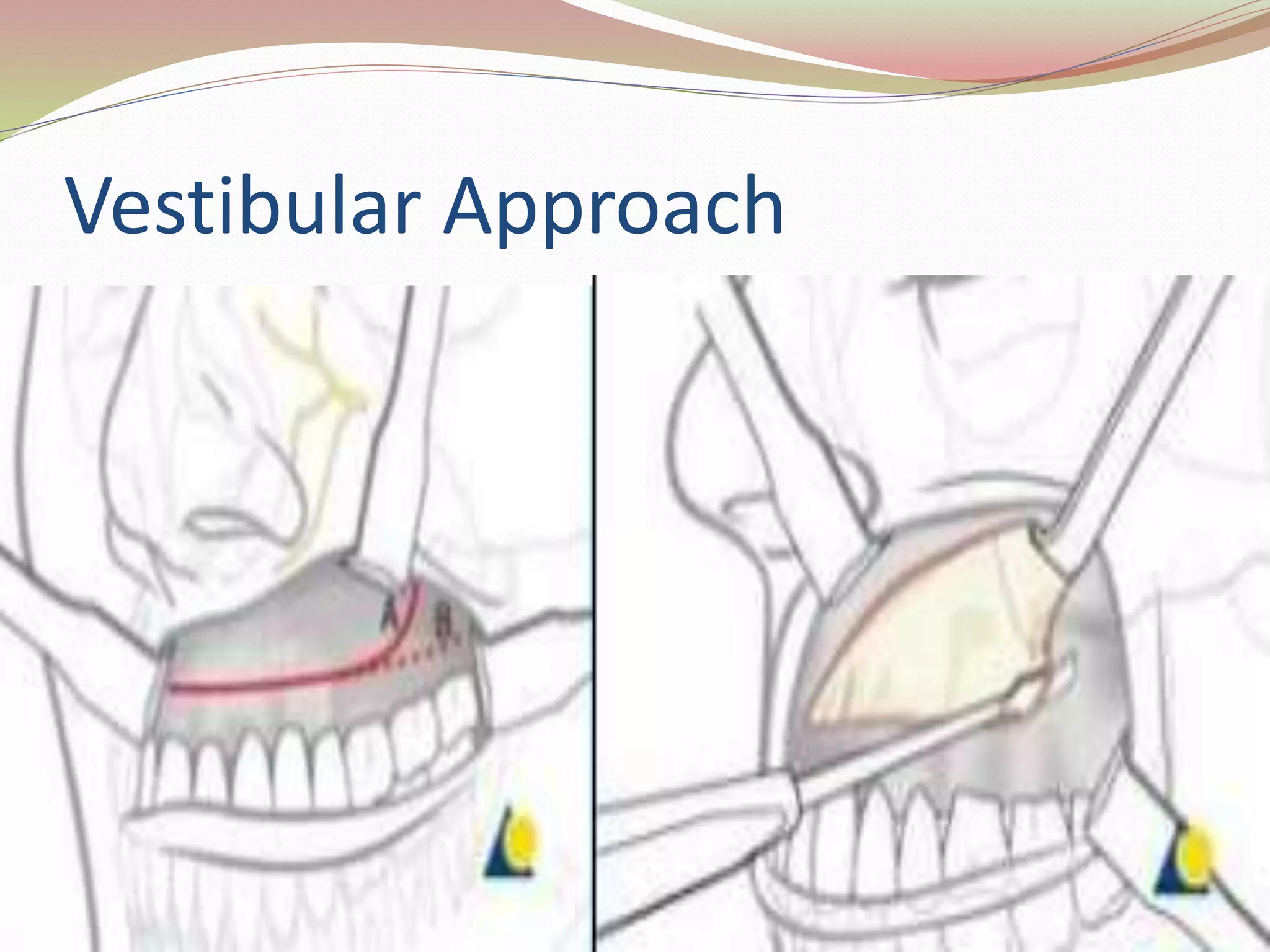 Management of zygomatic complex fractures | PPTX