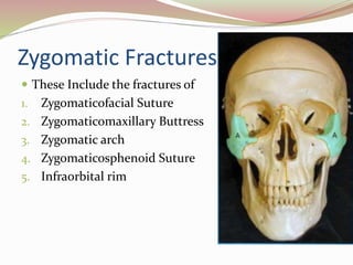 Management of zygomatic complex fractures | PPTX