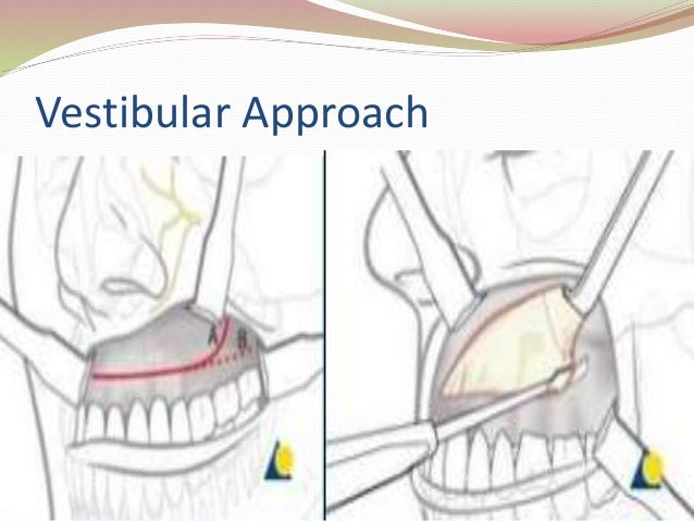Zygomatic Maxillary Complex Fracture