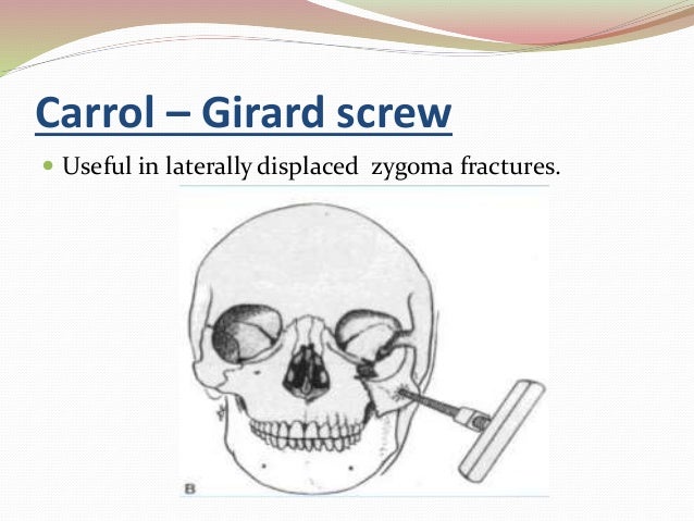 Management of zygomatic complex fractures