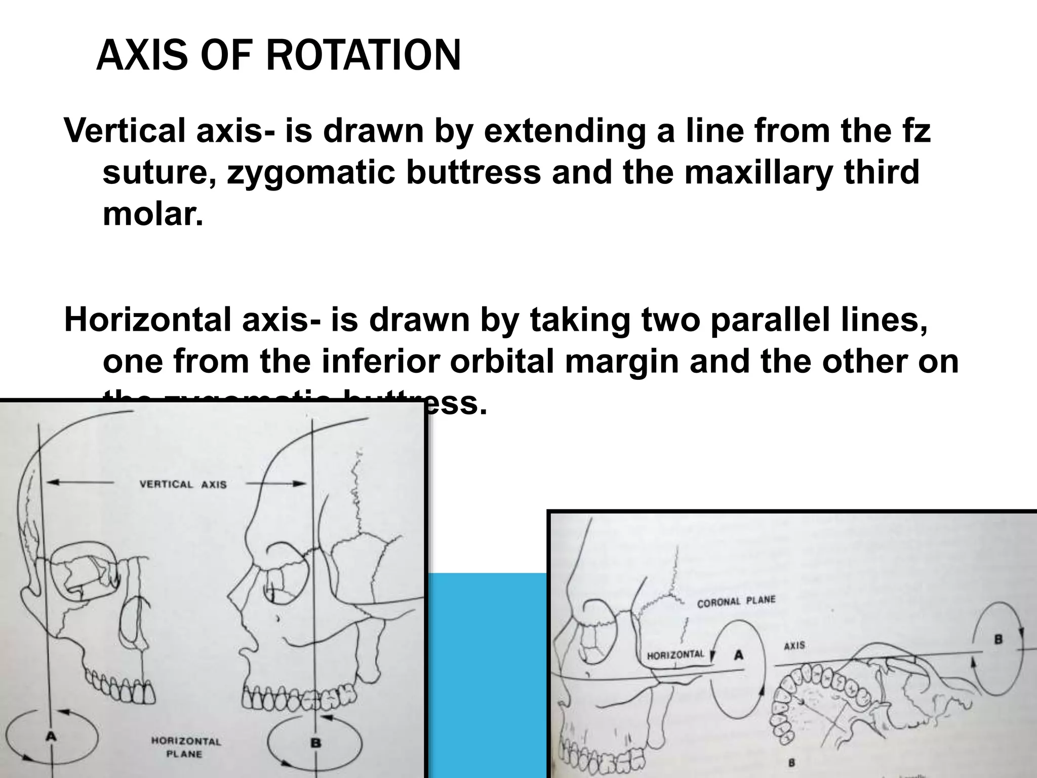 Management of zygomaticomaxillary complex fractures ih | PPTX