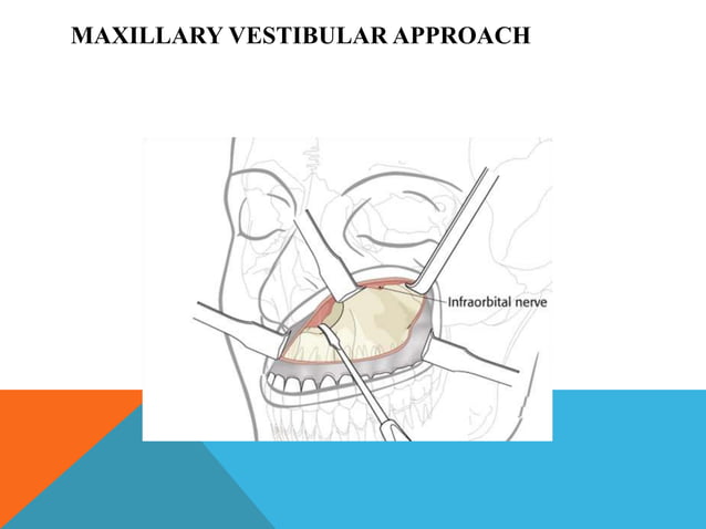 Management of zygomaticomaxillary complex fractures ih | PPTX