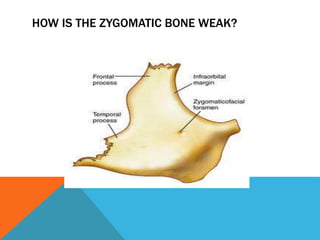 Management of zygomaticomaxillary complex fractures ih | PPTX