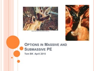 Management options in massive and submassive pulmonary embolus | PPTX