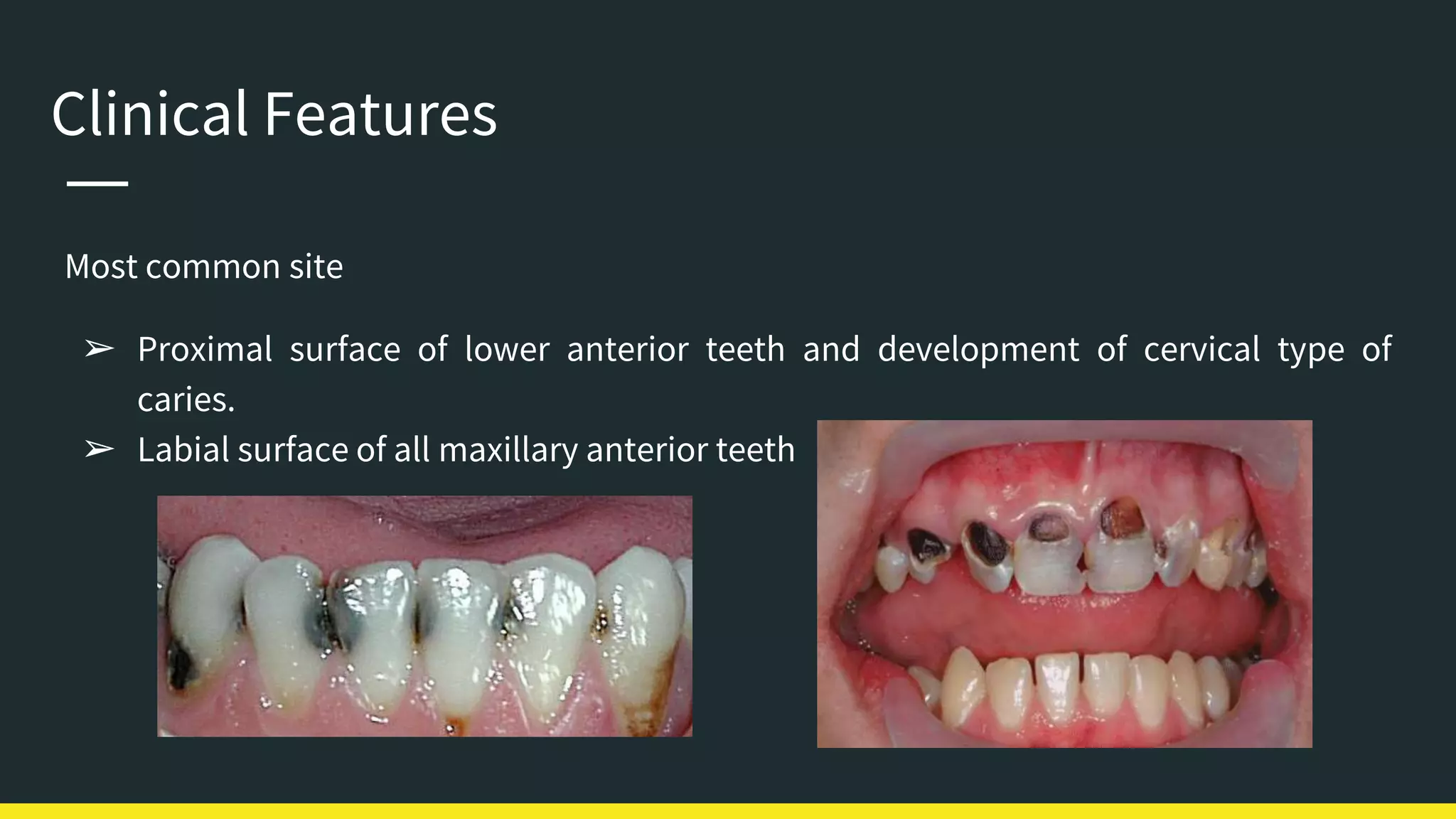 Management & Prevention of early childhood caries | PPTX