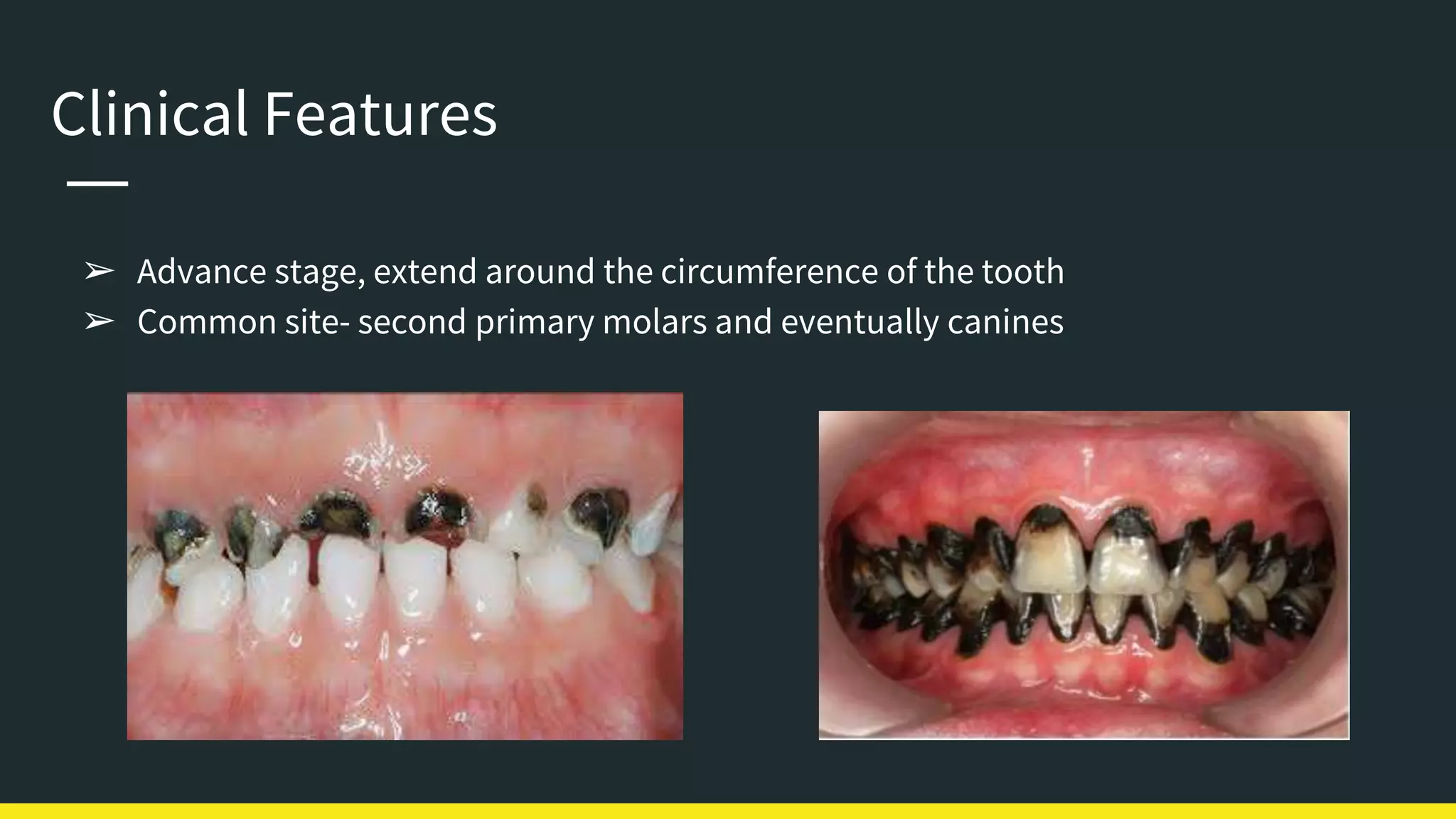 Management & Prevention of early childhood caries | PPTX