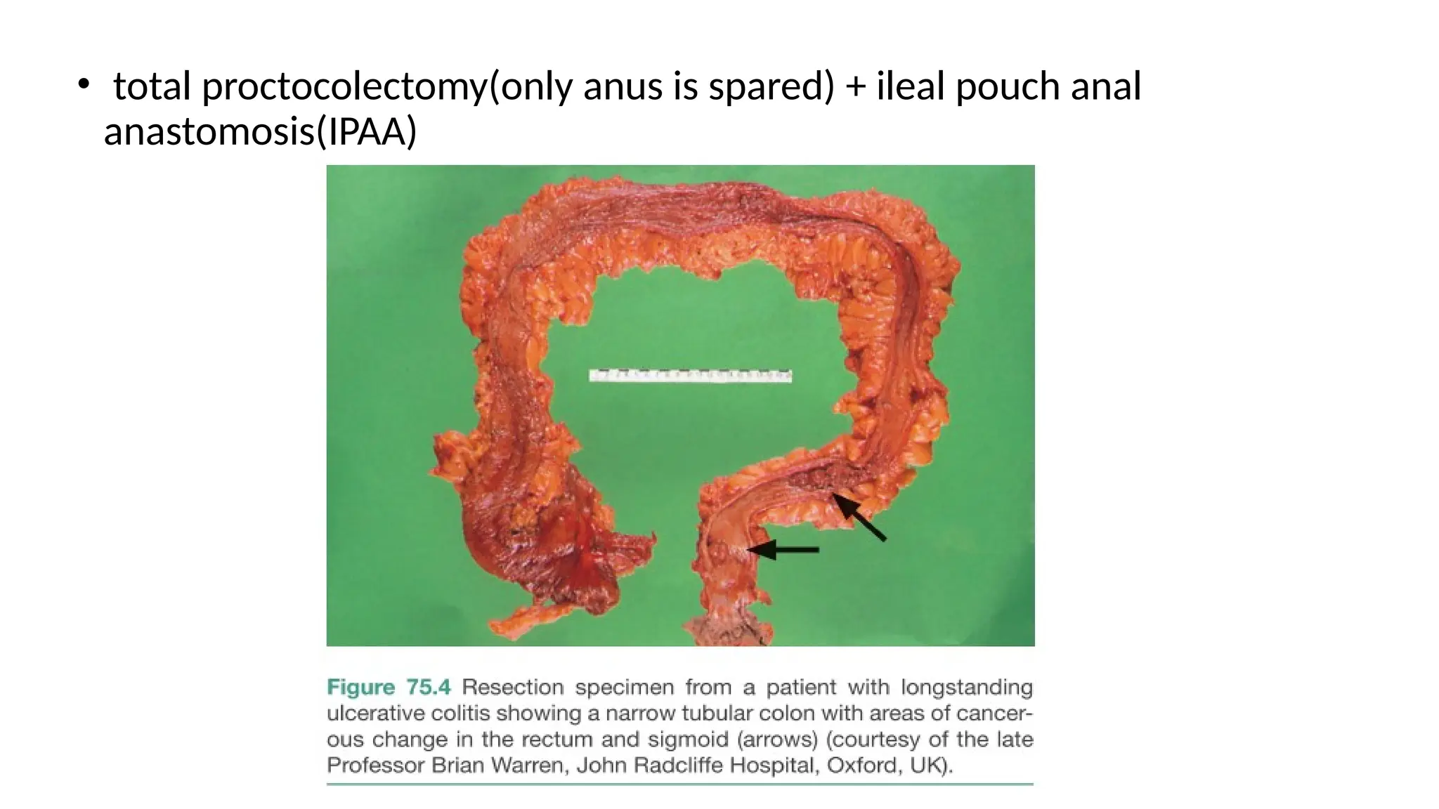Management principles of inflammatory bowel disease.pptx
