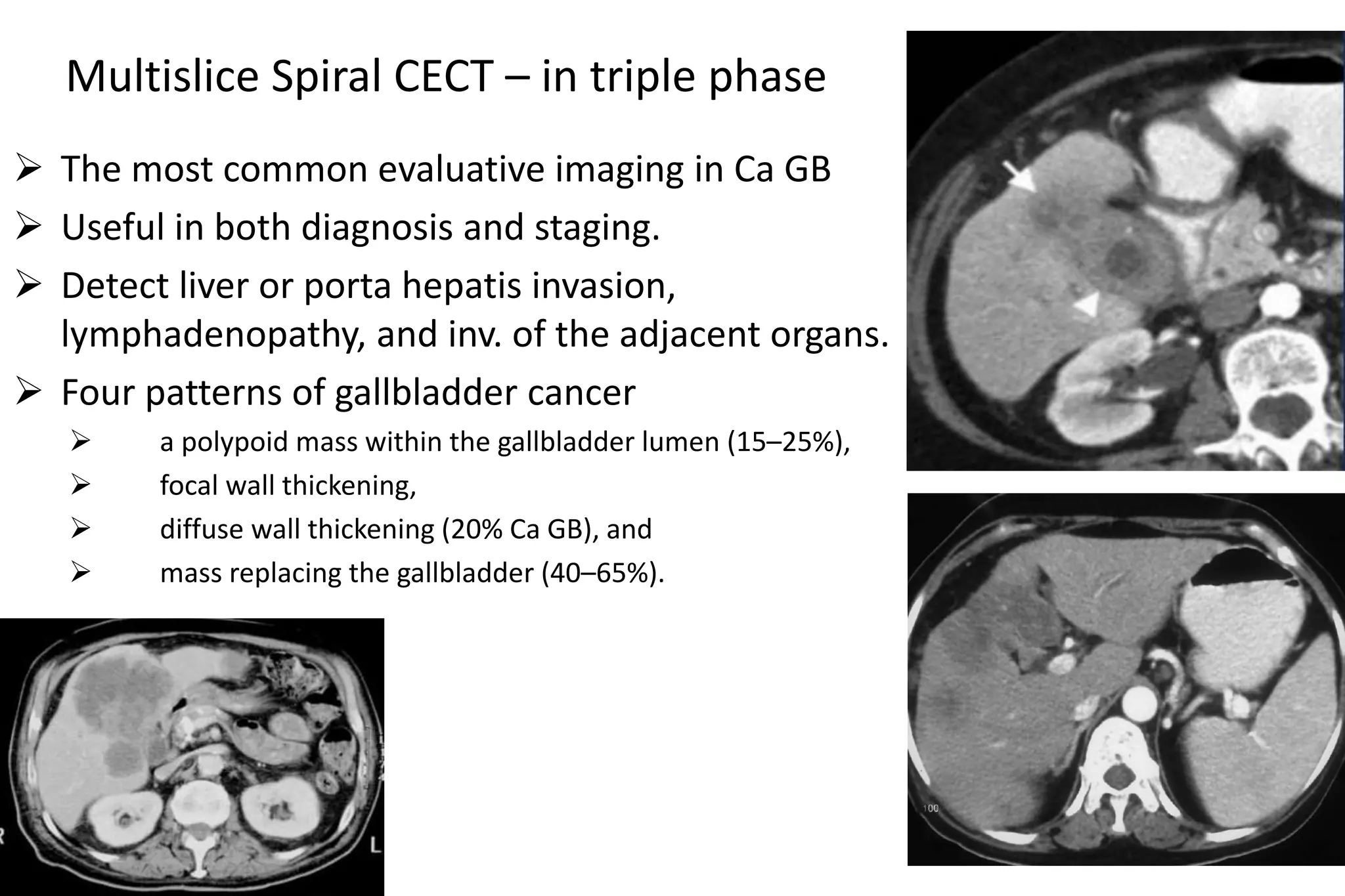 Management strategy in cancer gall bladder | PPT
