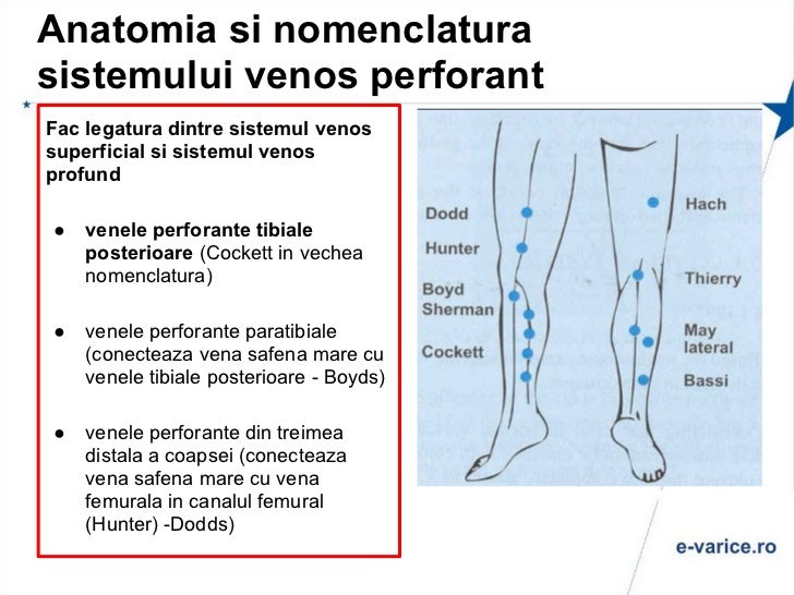 Managementul pacientilor cu varice