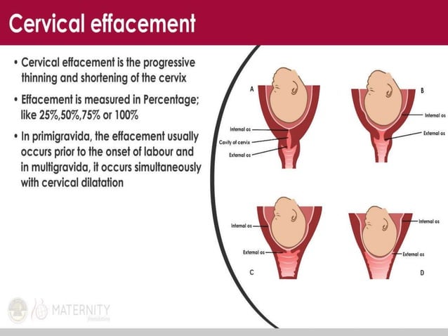 MANAGEMNET OF STAGES OF LABOUR and amtsl.pptx