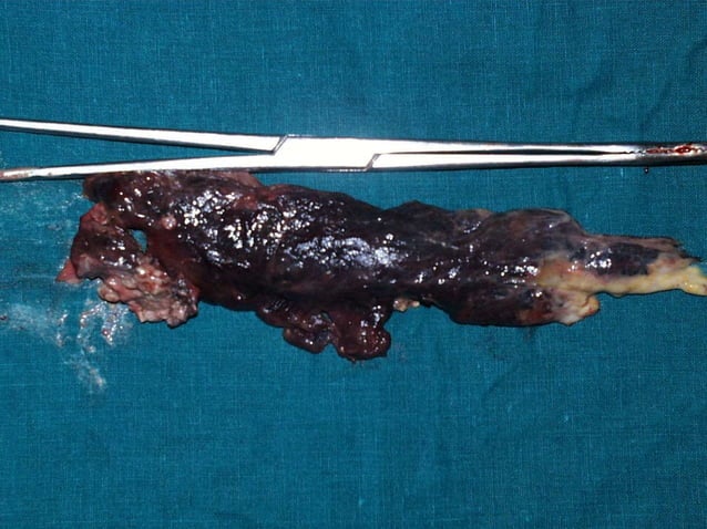 Managemnt of pancreatic necrosis and fluid collection | PPTX
