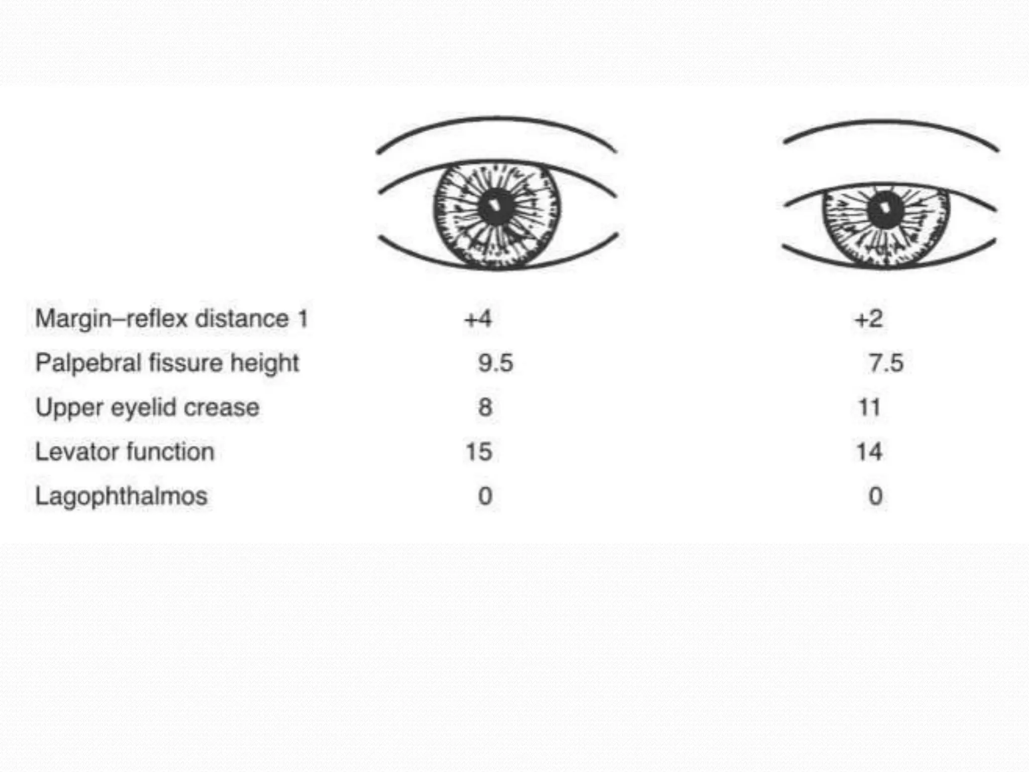 managemwnt of ptosis.pptx