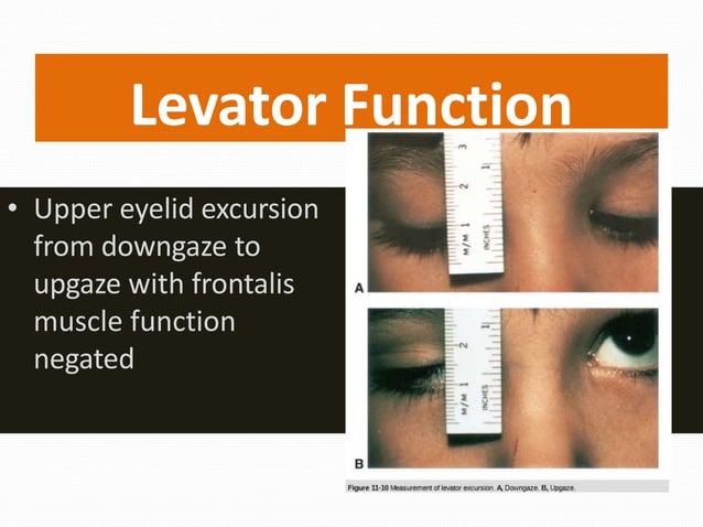 managemwnt of ptosis.pptx