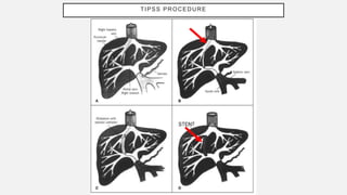 Managing acute upper gi bleeding | PPTX
