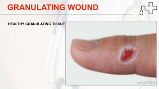 Managing Basic Wound Care in Nursing Home | PPT