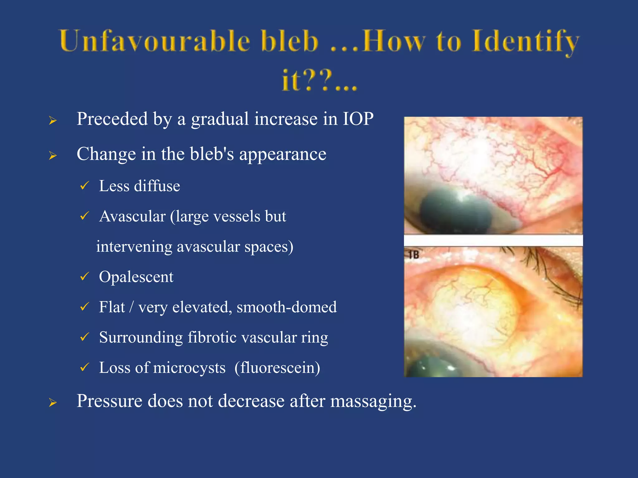 Managing bleb failure - A brief guide | PPTX