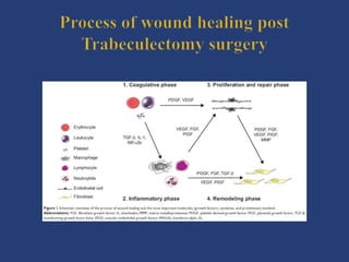 Managing bleb failure - A brief guide | PPTX