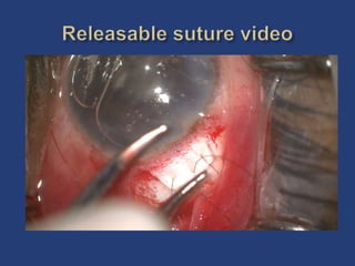 Managing bleb failure - A brief guide | PPTX