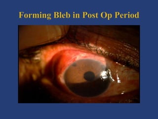 Managing bleb failure - A brief guide | PPTX