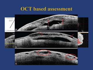 Managing bleb failure - A brief guide | PPTX