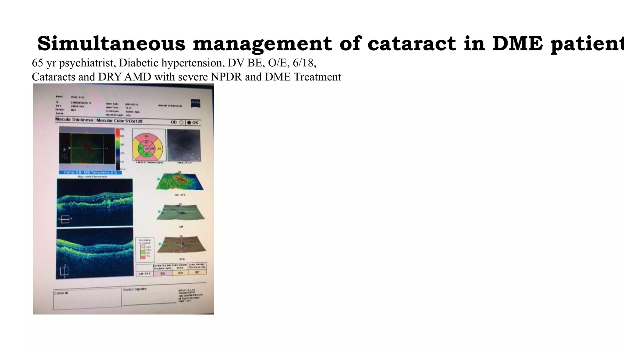 Managing cataract in DME patients simULTANEOUS injection and ...