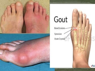 Managing Gout.pptx