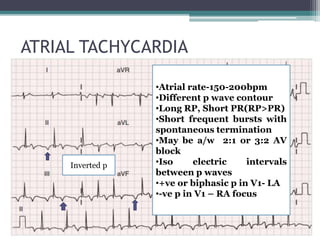 Managing supraventricular tachyarrythmias | PPTX