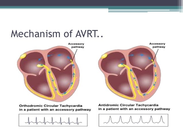 Managing supraventricular tachyarrythmias