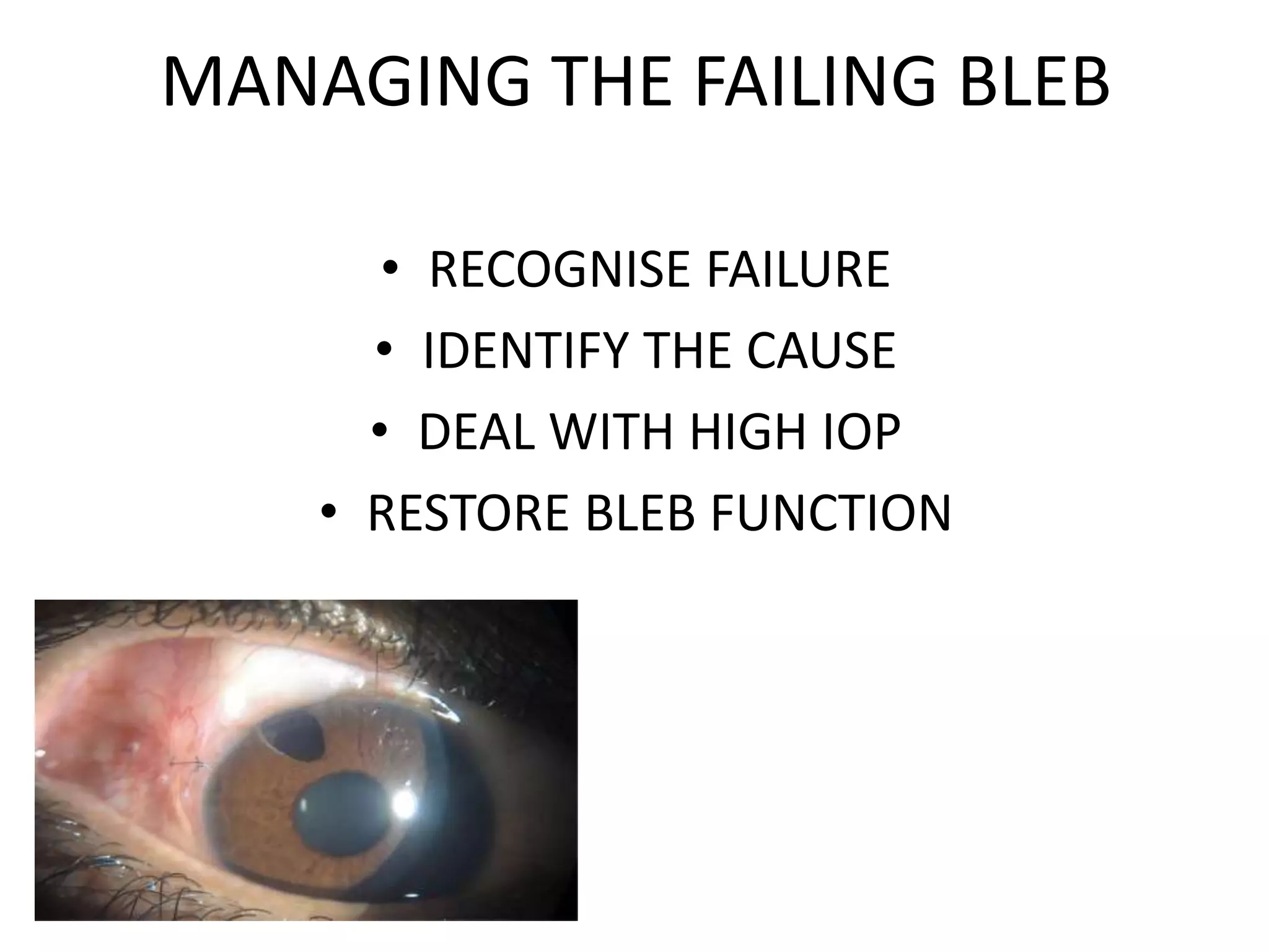 Managing the failing bleb | PPTX
