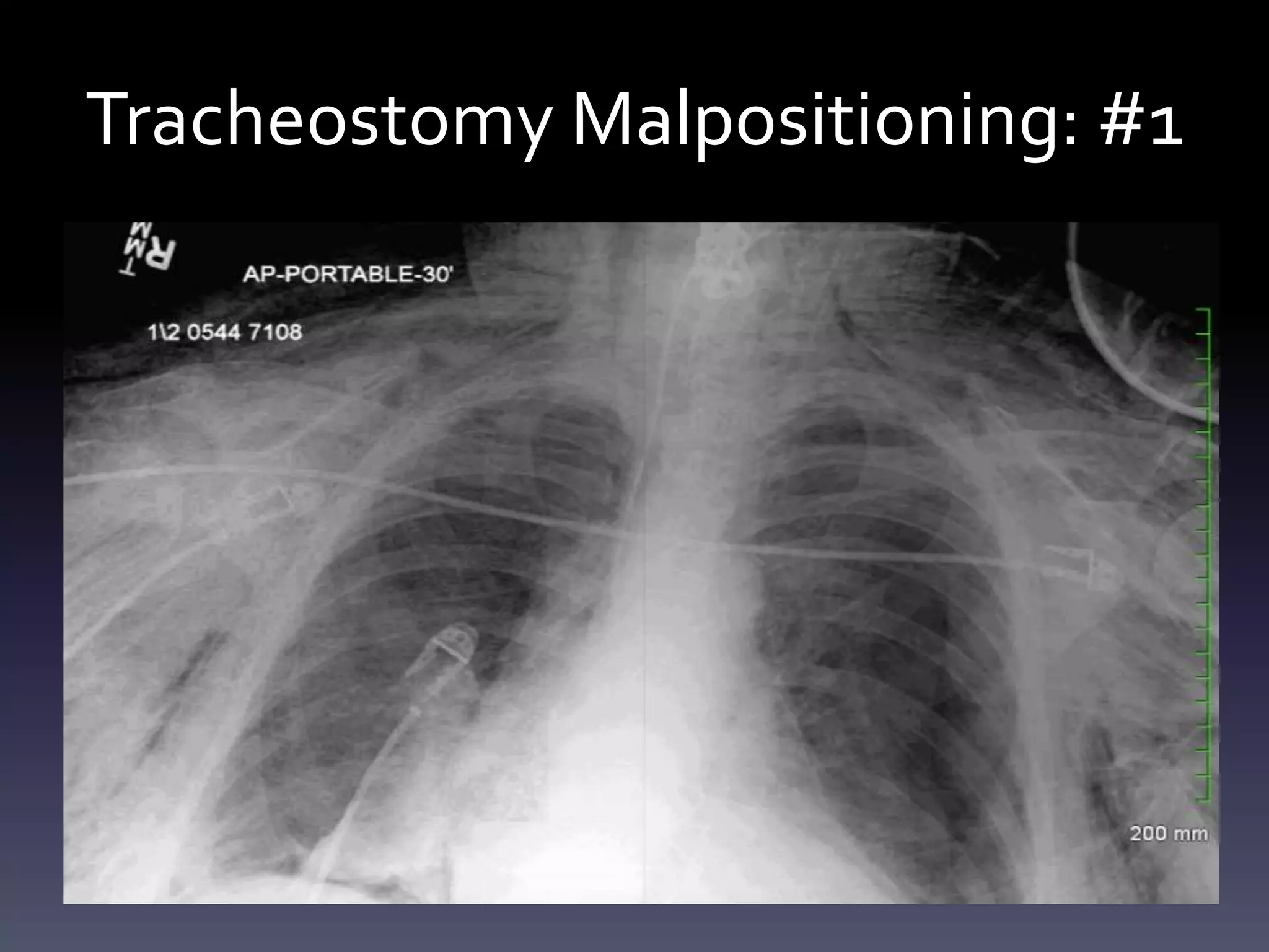 Tracheostomy Malpositioning: Managing Tracheostomy Displacement Events ...