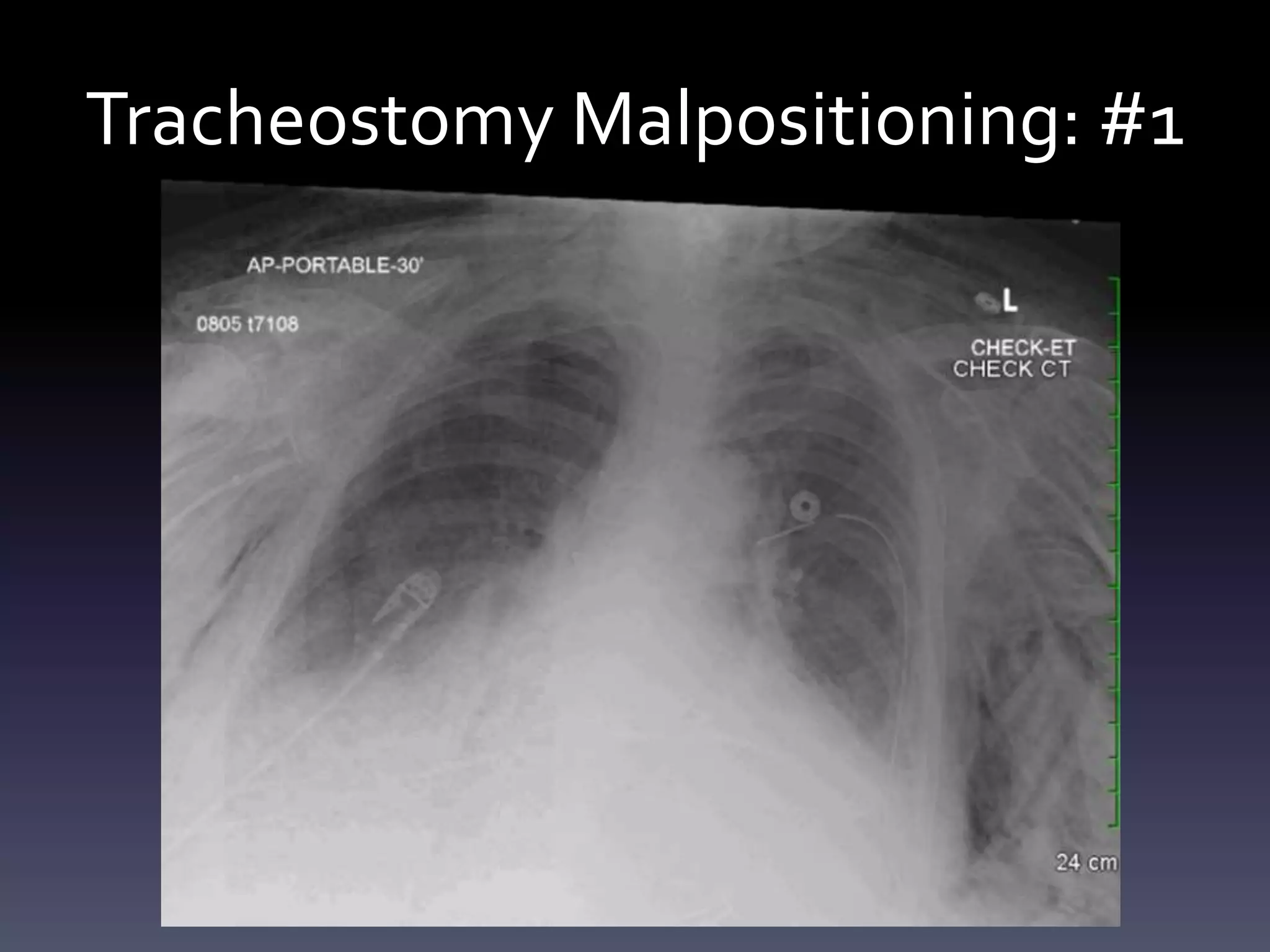 Tracheostomy Malpositioning: Managing Tracheostomy Displacement Events ...