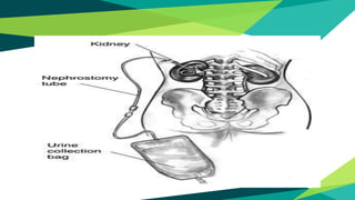 Management Nefrostomi of Nursing For Patient.ppt