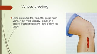 Managment of external venous | PPT