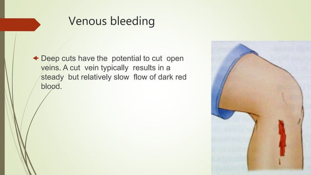 Managment of external venous | PPT