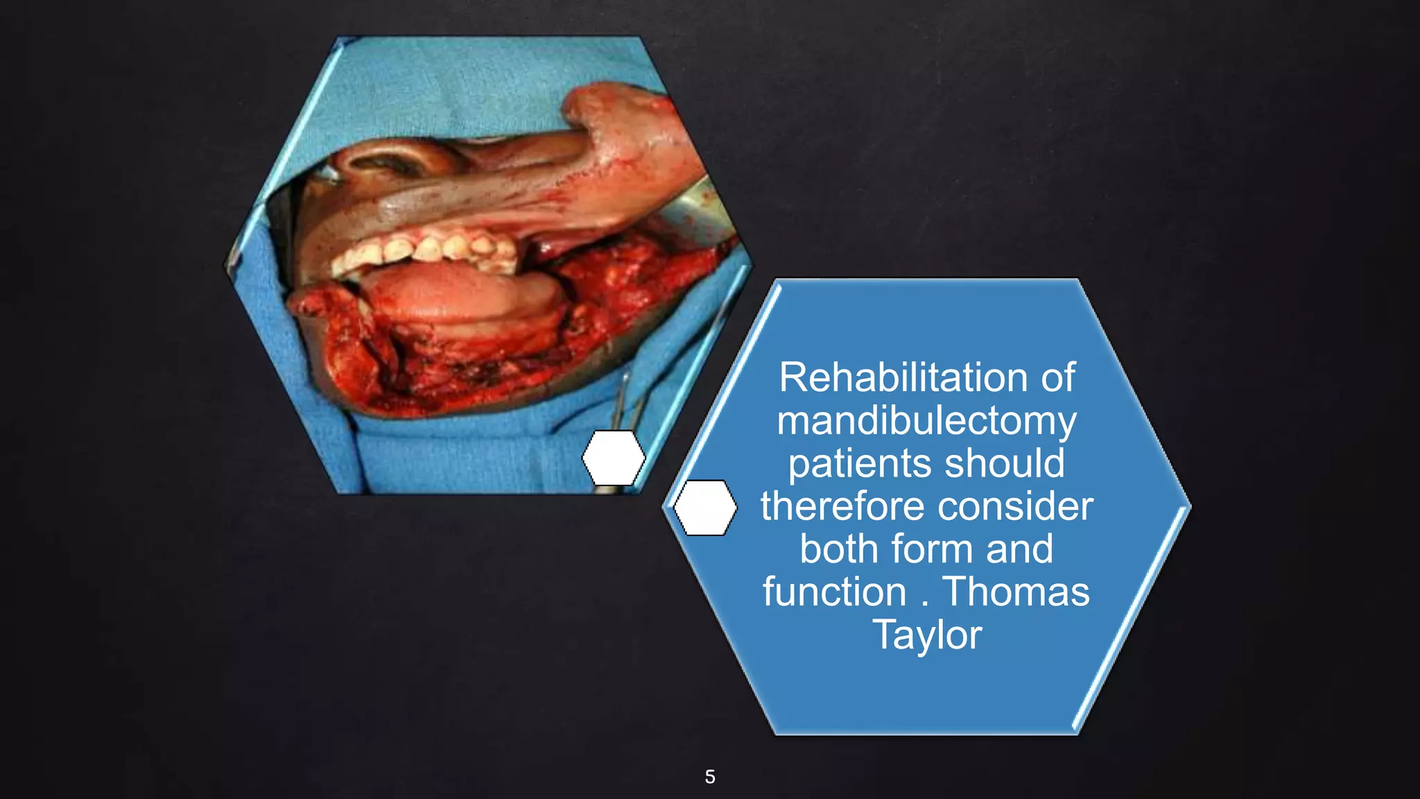 Managment of hamimandibulectomy | PPTX