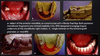 Managment of hamimandibulectomy | PPTX