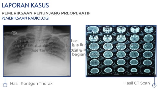 MANAJEMEN ANESTESI PADA KASUS PASIEN PREEKLAMSIA DENGAN PERDARAHAN ...