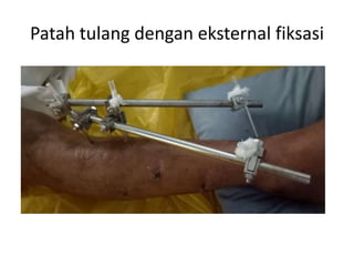 Manajemen Patah Tulang Terbuka.pptx