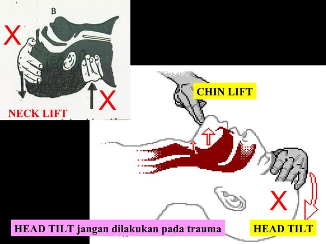 Manajemen sumbatan jalan napas | PPT