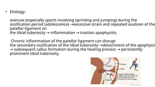 manar files osgood shlutter disease by m | PPT