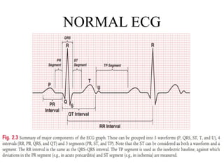 ECG how to read. Easy ECG. Simplified ECG.pptx