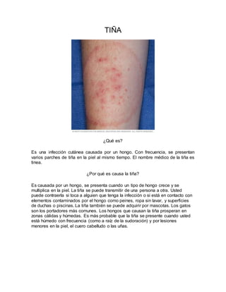 Manchas en el cuerpo humano, TIÑA, VITILIGO, ERITEMA, ECCEMA, PITRIASIS ...