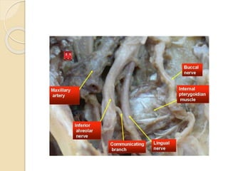 Mandibular Nerve Cadaver
