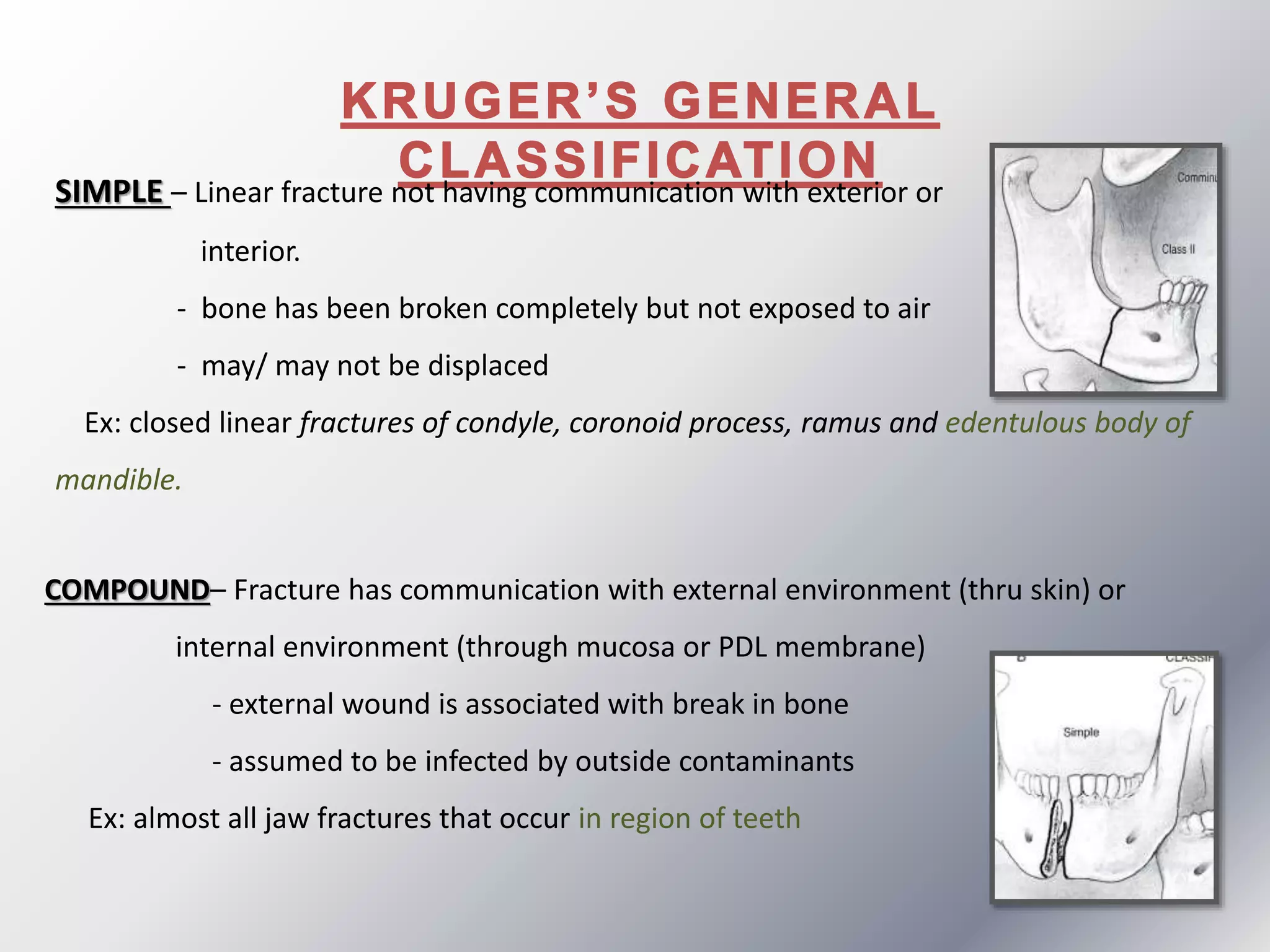 Mandibular fracture introduction i.h | PPTX