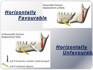 Mandibular fracture introduction i.h | PPTX