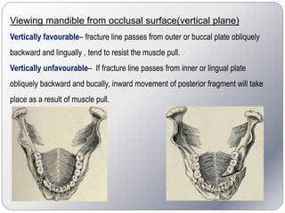 Mandibular fracture introduction i.h | PPTX
