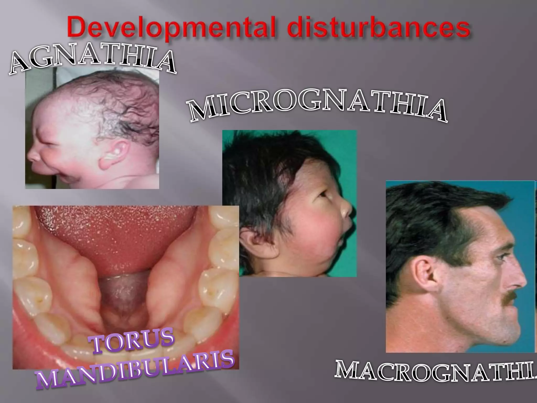 ANATOMY,DEVELOPMENT AND CLINICAL CONSIDERATION OF Mandible | PPT
