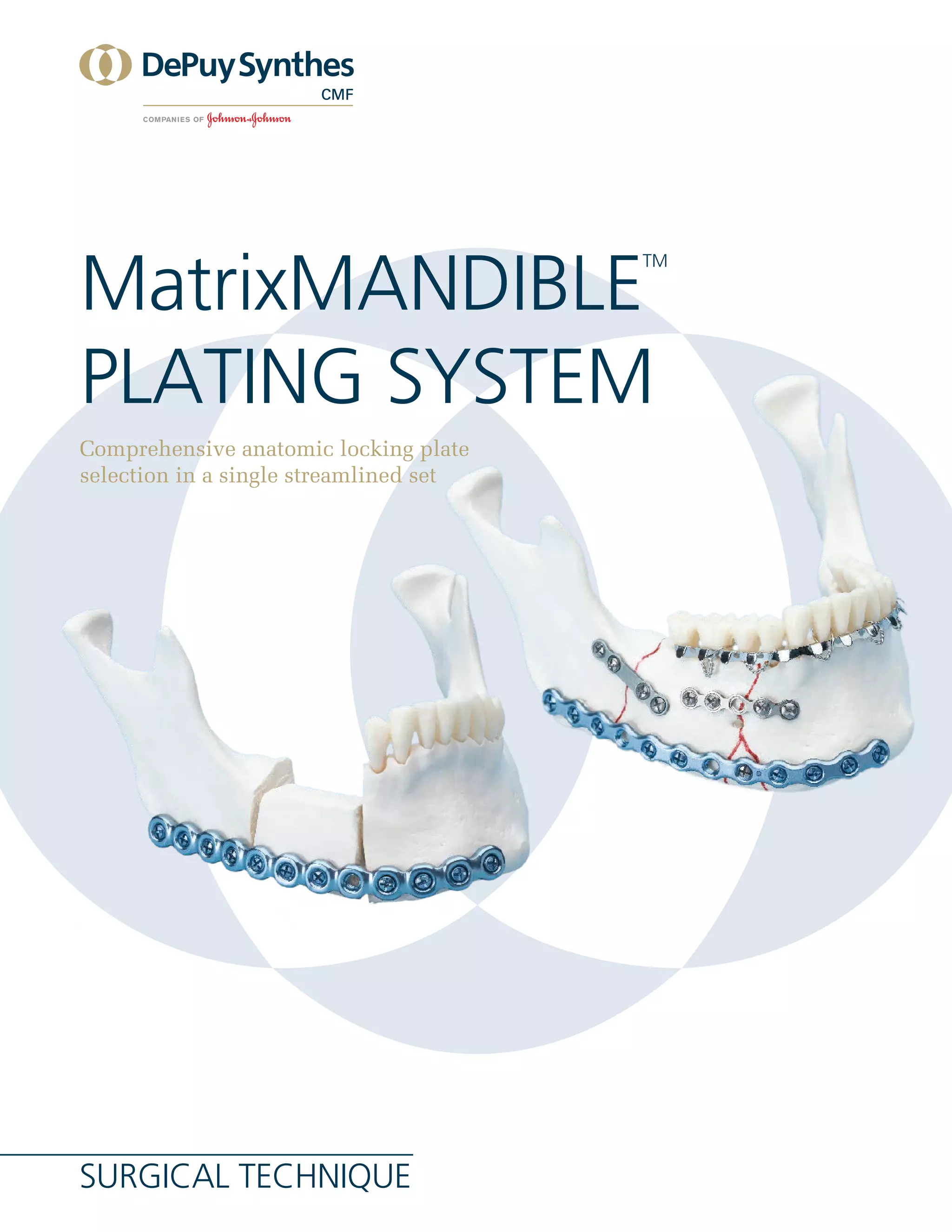 maxillofacial surgery implants | PDF